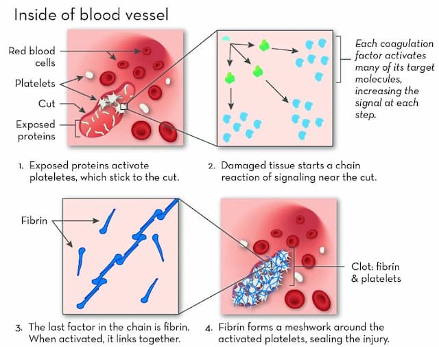 Matthew Liang | Hemophilia | Elio Academy